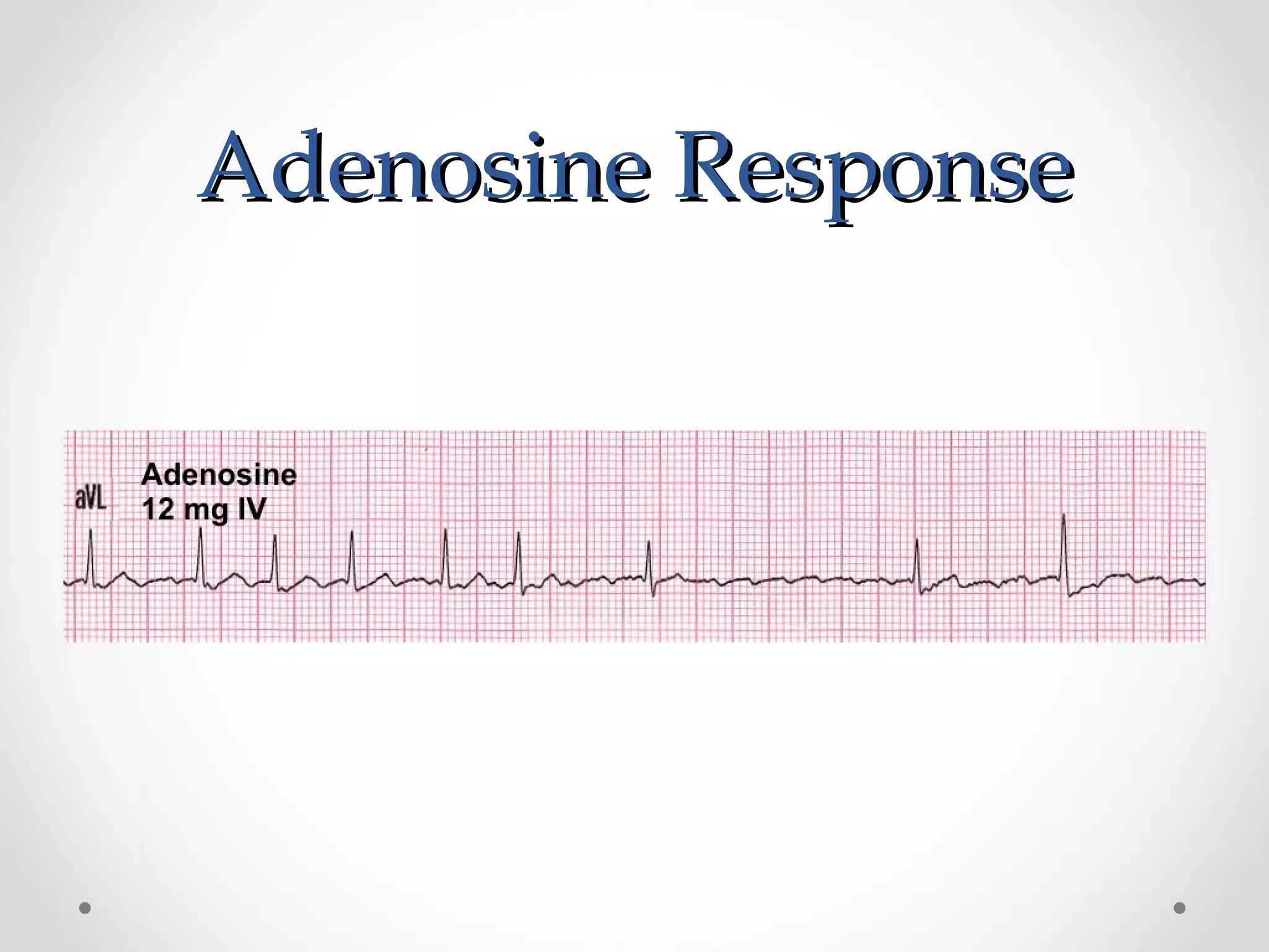 SVT in pediatrics | PPT