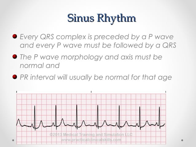 SVT in pediatrics | PPT | Heart and Cardiovascular Diseases | Diseases ...