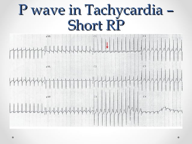 SVT in pediatrics | PPT | Heart and Cardiovascular Diseases | Diseases ...