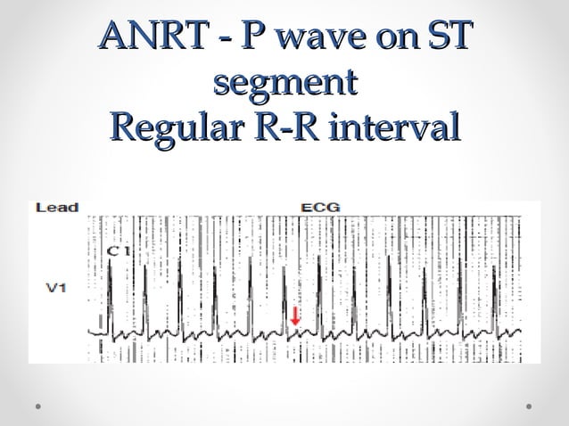 SVT in pediatrics | PPT | Heart and Cardiovascular Diseases | Diseases ...