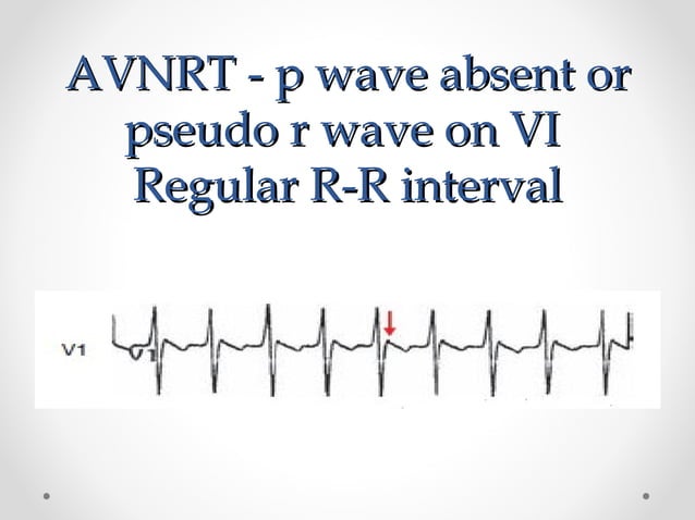 SVT in pediatrics | PPT | Heart and Cardiovascular Diseases | Diseases ...