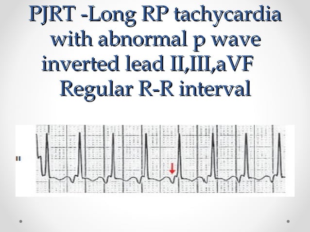 SVT in pediatrics | PPT | Heart and Cardiovascular Diseases | Diseases ...