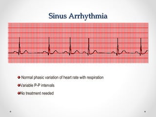 SVT in pediatrics | PPT