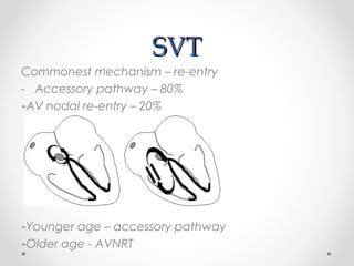 SVT in pediatrics | PPT