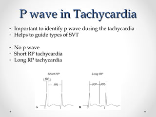 SVT in pediatrics | PPT