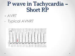 SVT in pediatrics | PPT
