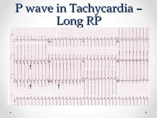 SVT in pediatrics | PPT