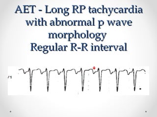 SVT in pediatrics | PPT
