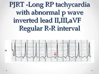 SVT in pediatrics | PPT