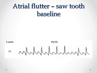 SVT in pediatrics | PPT