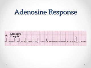 SVT in pediatrics | PPT