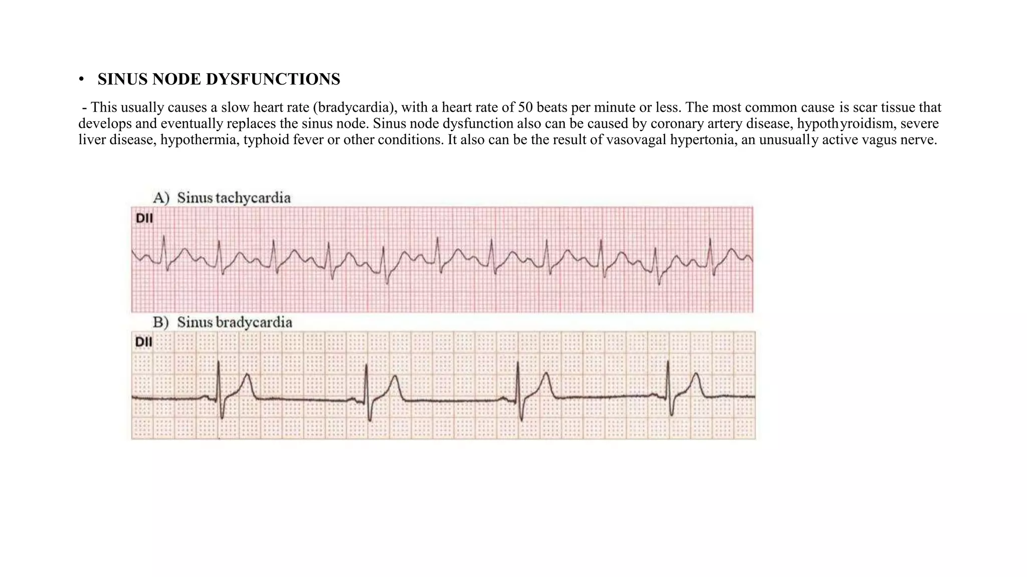 Cardiac arrhythmia. | PPTX