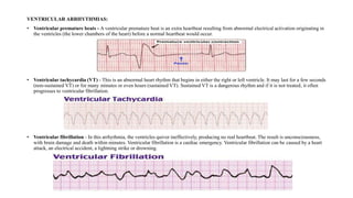 Cardiac arrhythmia. | PPTX