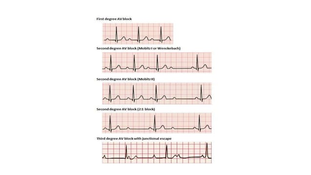 Cardiac arrhythmia. | PPTX | Heart and Cardiovascular Diseases ...