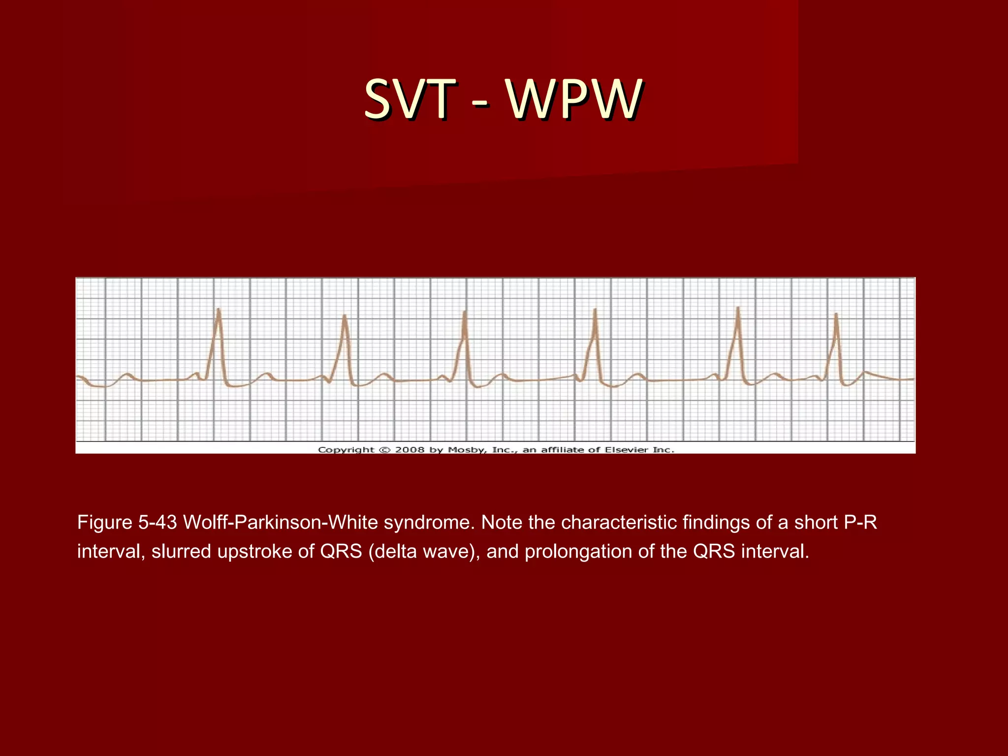 Arrhythmia broad overview | PPT