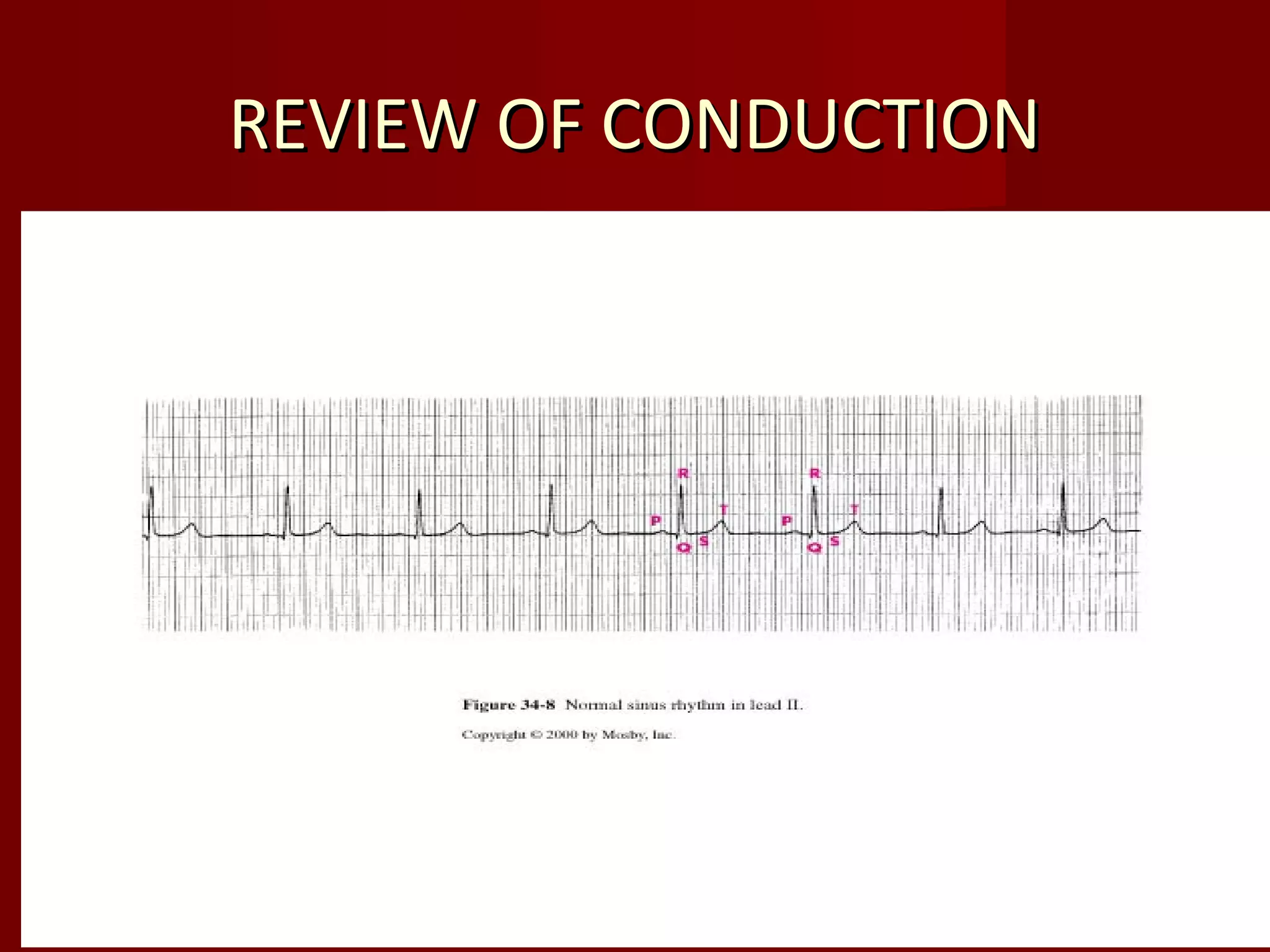 Arrhythmia broad overview | PPT