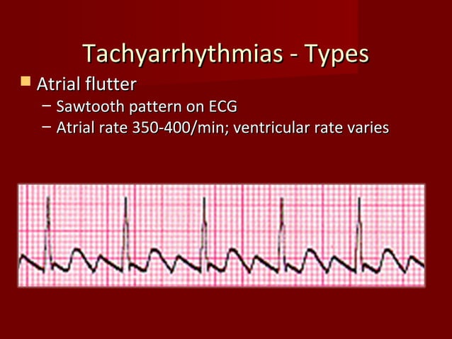 Arrhythmia broad overview | PPT