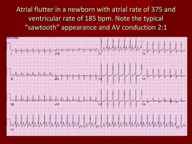 Arrhythmia broad overview | PPT