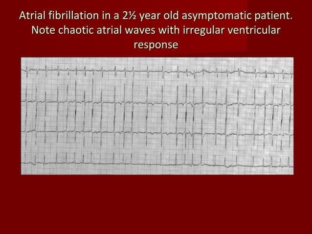 Arrhythmia broad overview | PPT