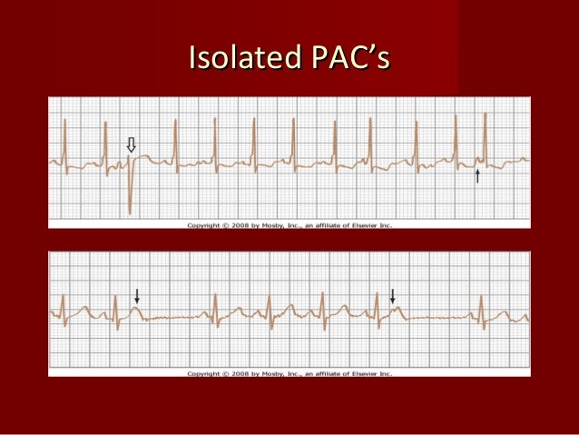 Arrhythmia broad overview