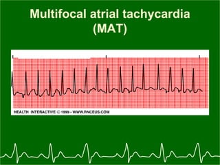 Cardiac arrhythmia1.ppt3