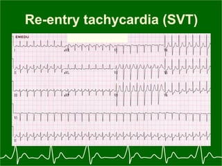 Cardiac arrhythmia1.ppt3