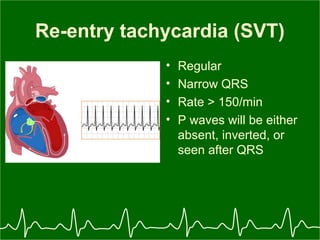 Cardiac arrhythmia1.ppt3