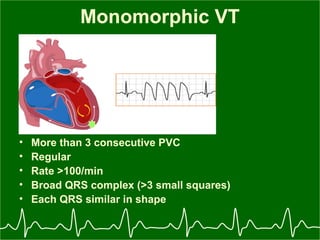 Cardiac arrhythmia1.ppt3