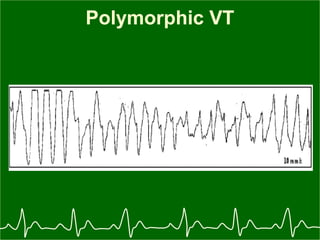 Cardiac arrhythmia1.ppt3