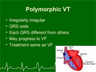 Cardiac arrhythmia1.ppt3