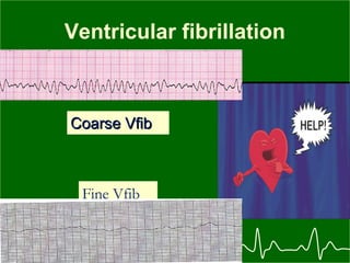 Cardiac arrhythmia1.ppt3