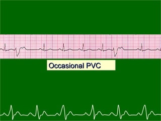 Cardiac arrhythmia1.ppt3