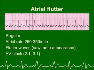 Cardiac arrhythmia1.ppt3