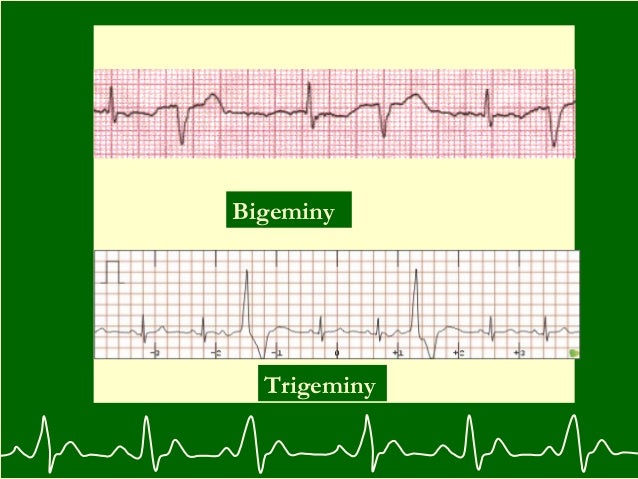 Cardiac arrhythmia1.ppt3