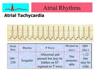 Cardiac arrhythmias | PPT