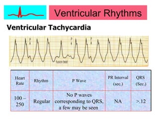 Cardiac arrhythmias | PPT