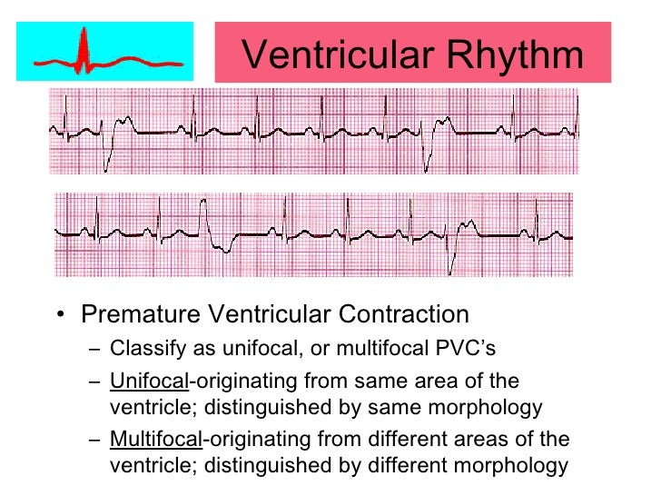 unifocal premature ventricular contractions - hiccups pregnancy
