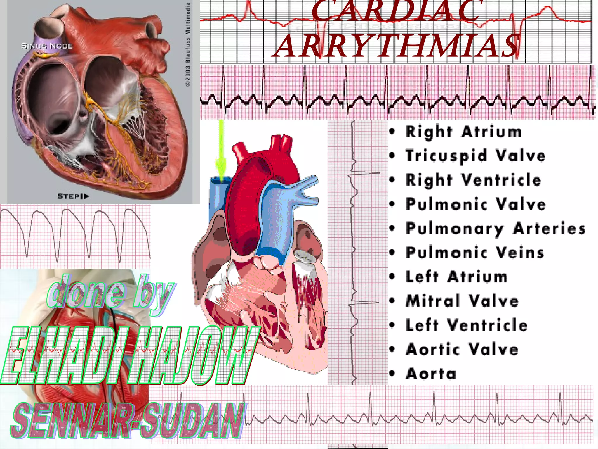 Cardiac arrhythmias | PPT