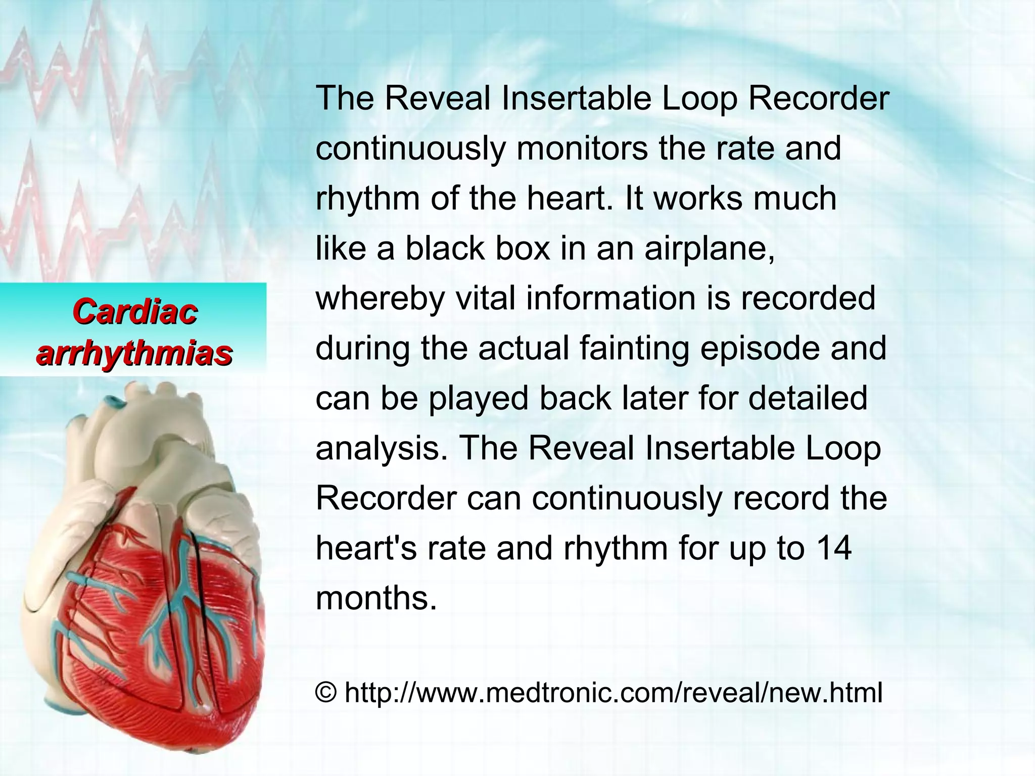 Cardiac arrhythmias | PPT