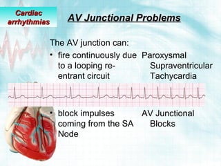 Cardiac arrhythmias | PPT