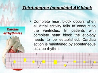 Cardiac arrhythmias | PPT