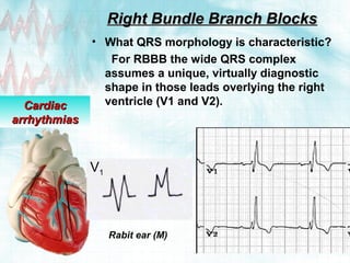 Cardiac arrhythmias | PPT