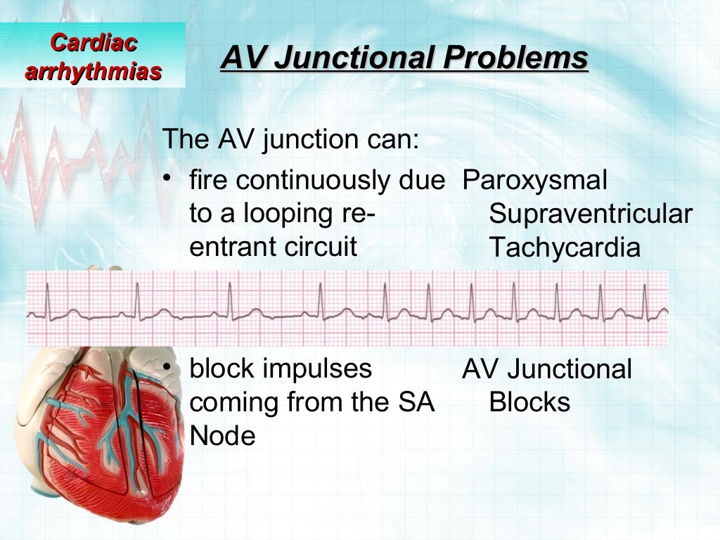 Cardiac Arrhythmia