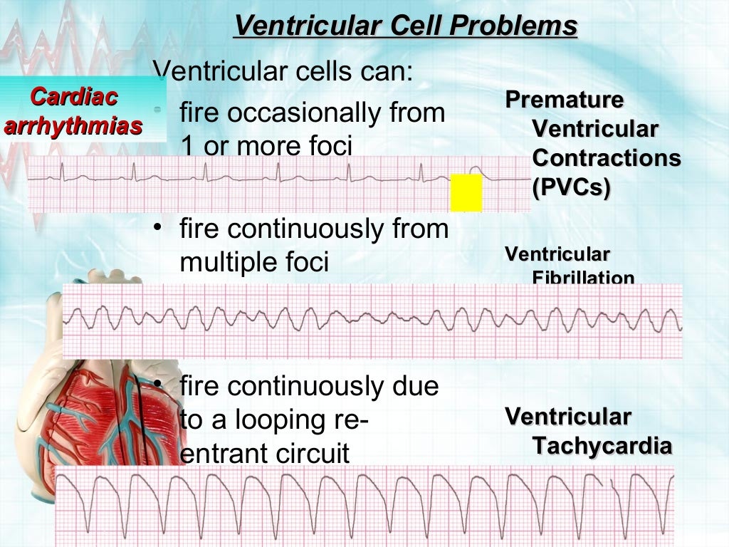 Cardiac arrhythmias