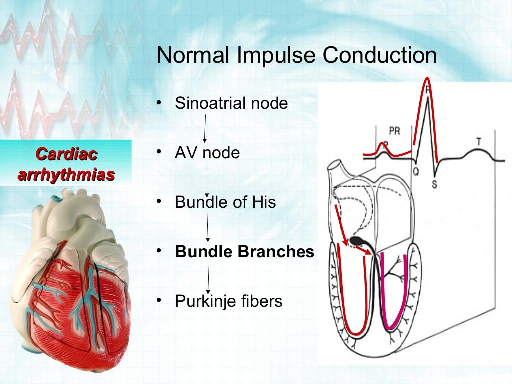 Cardiac Arrhythmia