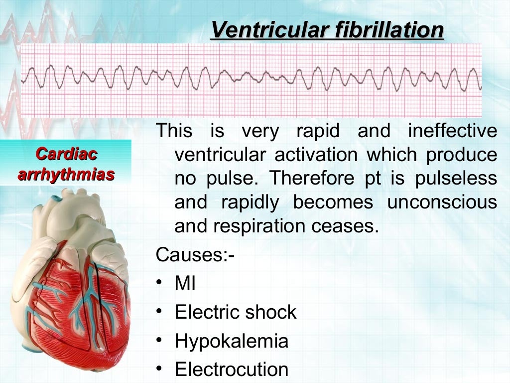 Cardiac arrhythmias