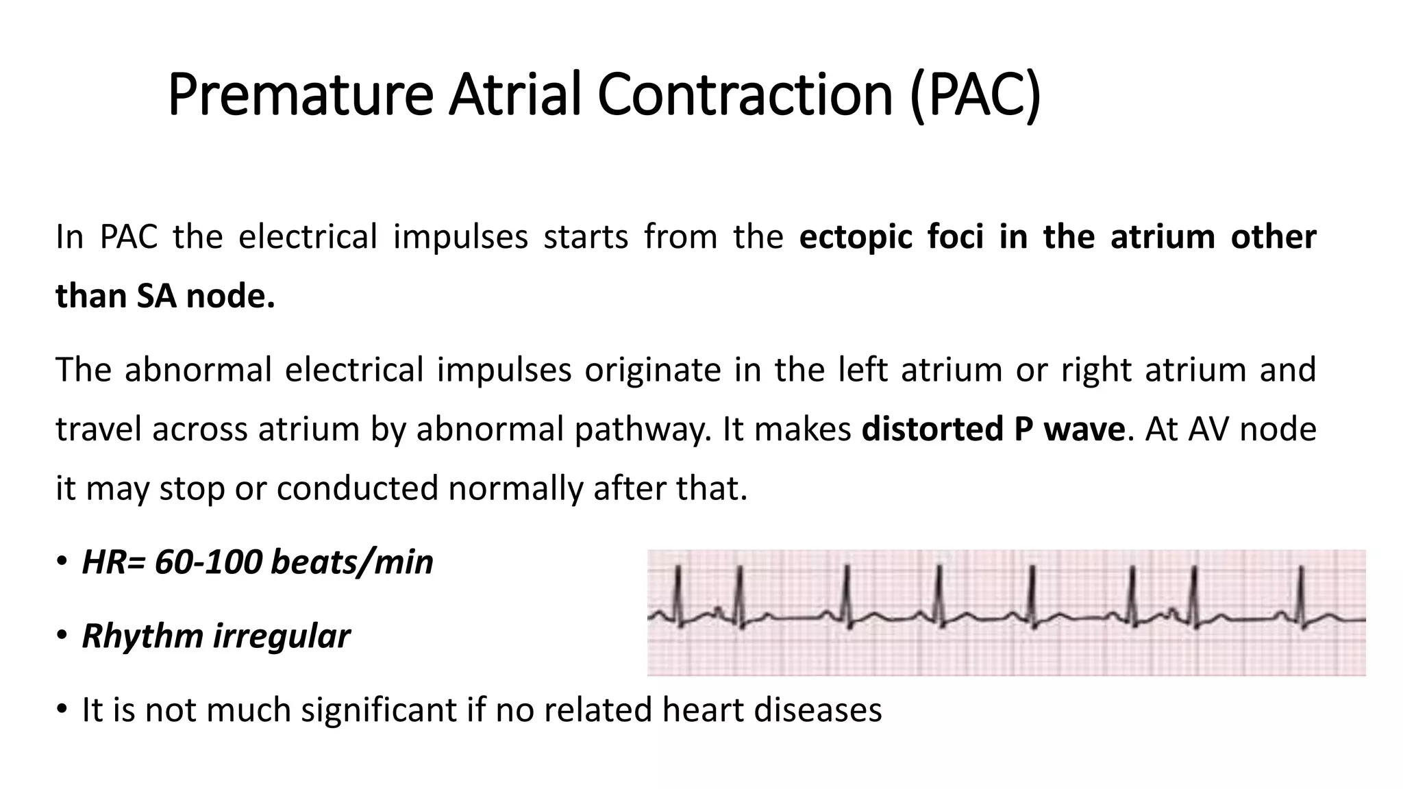 Cardiac arrhythmias | PPTX