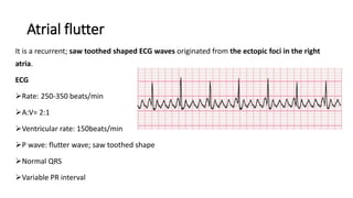 Cardiac arrhythmias | PPTX