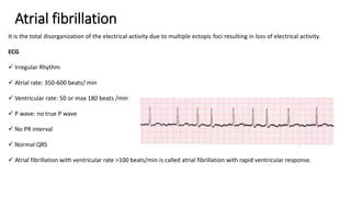 Cardiac arrhythmias | PPT