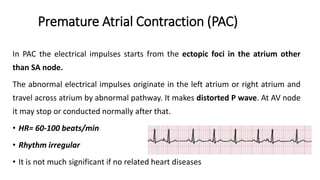 Cardiac arrhythmias | PPTX